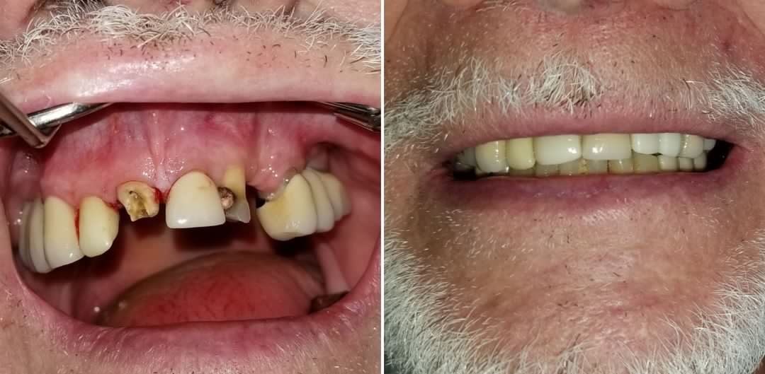 Affordable Dental Implants - Dr. Mj Alamiri - clarksville Dentures and ...