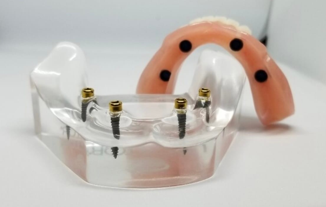 Snap-In Dentures in TN | Clarksville Dentures and Implants