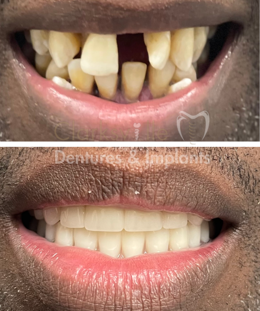 Before and After dental Implants - New Smile Transformation